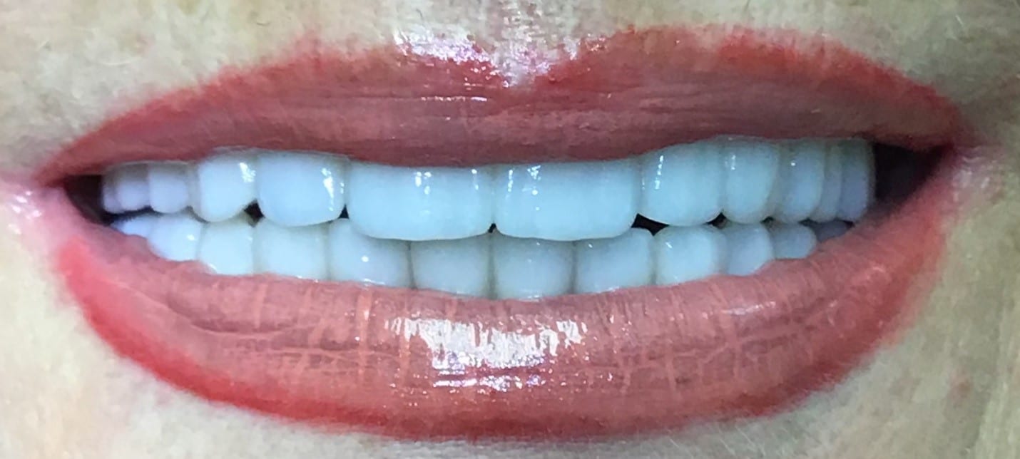 Dental Implants Hallandale Beach | Dental Implacts Miami FL