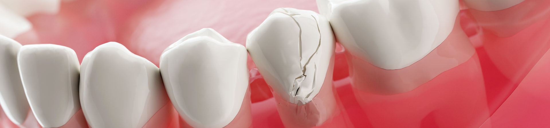 Chipped or Broken Tooth: What to Do & How to Treat?